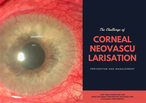 Managing Corneal Neovascularisation