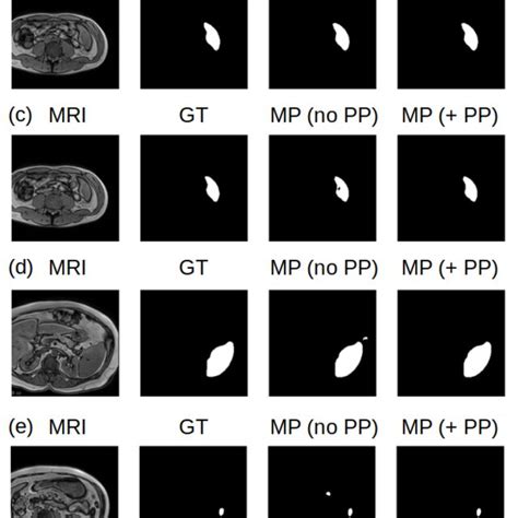 Examples Of Mri Slices First Column Their Gt Second Column The Mp