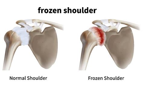 Frozen Shoulder Apicare Pain Specialist