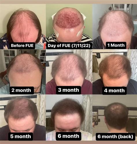 Hair Transplant Timeline Guide What To Expect Each Month