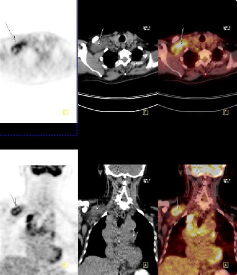 Petct Of The Neck Revealed Right Supraclavicular Lymph Node