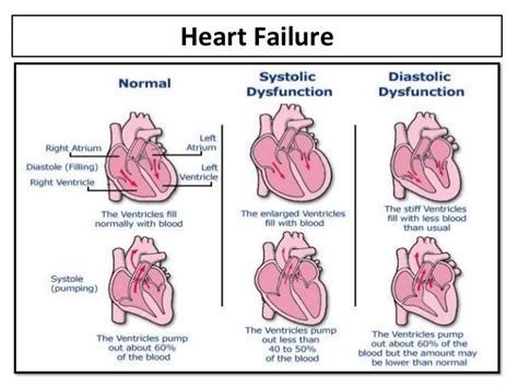 What Is Left Ventricular Dysfunction Nwew