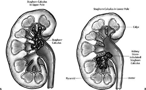 Percutaneous Nephrostomy Radiology Key
