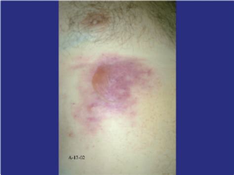 Superficial Burn Blisters With Epidermal Loss On Non Exposure Areas Download Scientific Diagram