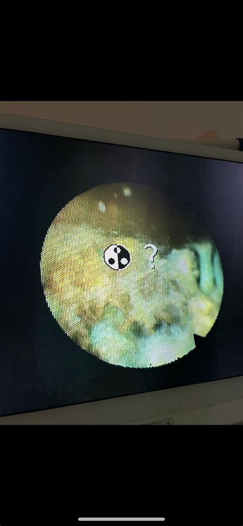 Ever Seen A Bladder Sling Transvaginal Mesh Erupt Through The Bladder