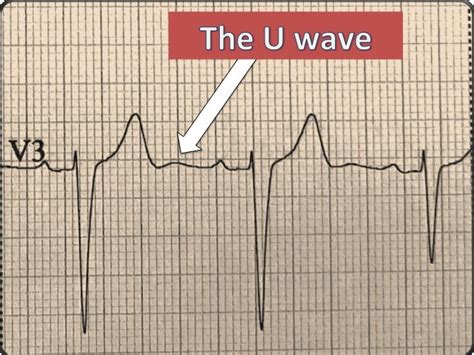 Ecg Segments And Intervals — The Pr