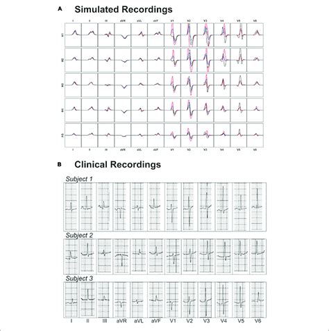 Comparison Between Simulated And Clinical 12 Lead Ecg Recordings