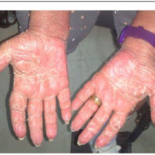 Diffuse Infiltrating Erythroderma Of The Lower Extremities Download Scientific Diagram