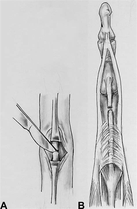 Treatment Of Swan Neck Deformity In Cerebral Palsy Journal Of Hand