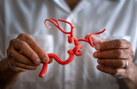 Get Brain Aneurysm Care Cleveland Clinic