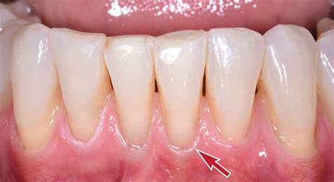 Mucogingival Junction Treatment Of Gingival Recession And Root