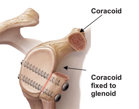 Shoulder Stabilisation Surgery Gateshead Health