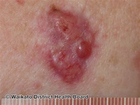 Basal Cell Carcinoma Causes Symptoms And Treatment In Columbus Ohio