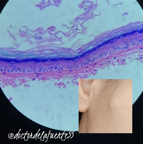 Doctor De La Fuente Un Quiste Epidermoide Es Un Saco Con