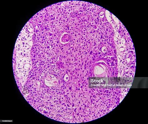 Photomicrograph Showing Tongue Squamous Cell Carcinoma Grade Ii Oral