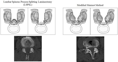 Comparison Of Modified Marmot Surgery And Lumbar Spinous Process