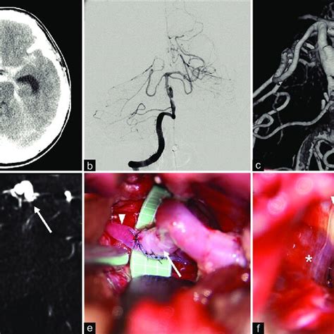 Preoperative Imaging And Intraoperative View A Preoperative Computed Download Scientific