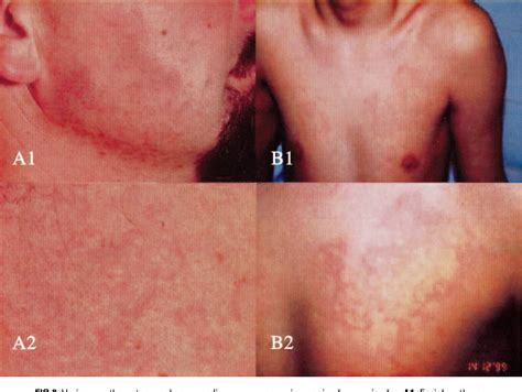 C Esterase Inhibitor Semantic Scholar