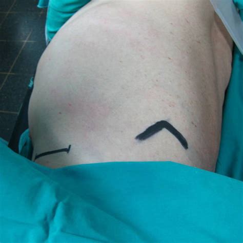 Pdf Open Thoracotomy For Pneumothorax