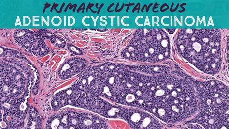 Adenoid Basal Cell Carcinoma Histology