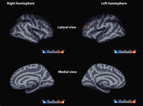 Freesurfer Whole Brain Vertex Wise Analysis Of Cortical Surface Area