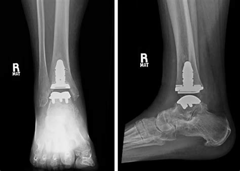 Ankle Replacement For Patients With Ankle Arthritis
