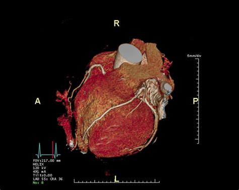 Heart Ct Scan In London Heart Health Echelon Health