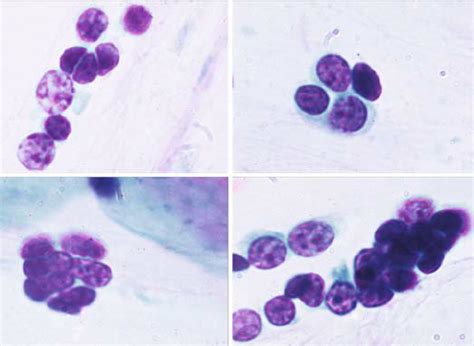 47 Poorly Preserved Columnar Epithelium And Reserve Cells Mimicking
