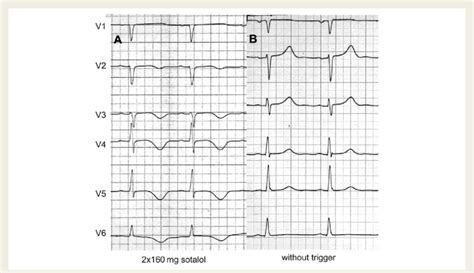 Electrocardiographic Example Of A Typical Acquired Long Qt Syndrome Download Scientific Diagram
