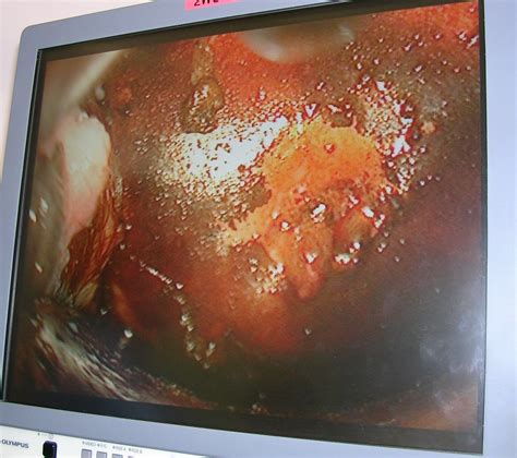 Colposcopy Leeplletz Beautiful Cervix Project