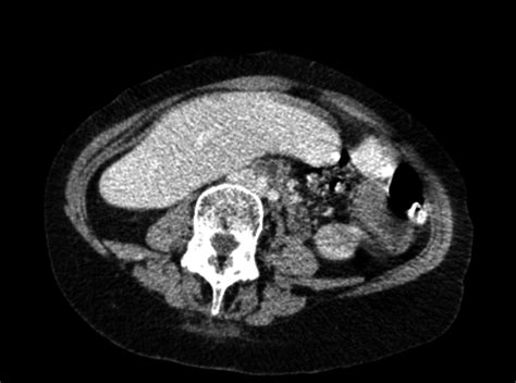 Abdominal Wall Musculature Before The Btx Injection Download Scientific Diagram