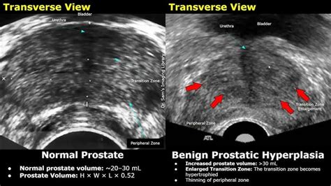 Prostate Anatomy Ultrasound Ultrasound Imaging June 2012