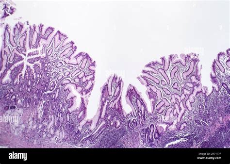 Histopathology Of Chronic Superficial Gastritis Light Micrograph