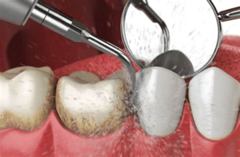 Behind The Smile An Untold Story Of Teeth Cleaning Side Effects