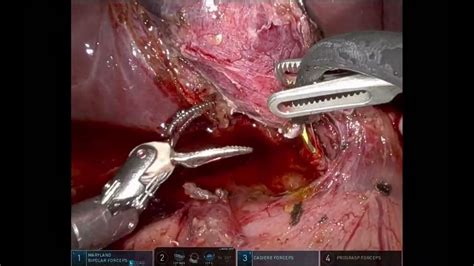 Robotic Transcystic Cbd Exploration Youtube