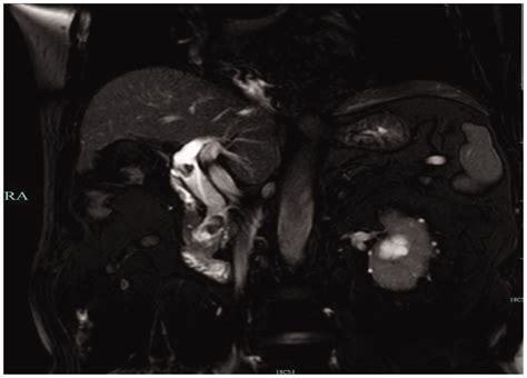 Multiple Nodular Filling Defects Are Observed In The Common Bile Duct Download Scientific Diagram