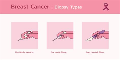 Infographic Biopsy Types Of Breast Cancer Stock Illustration Download