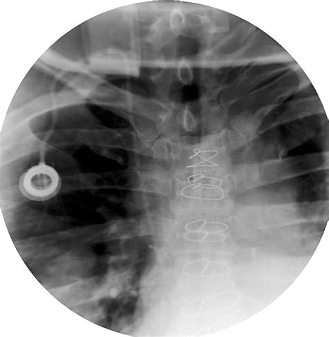 Part 2 Devices Of The Head Neck Spine Chest And Abdomen