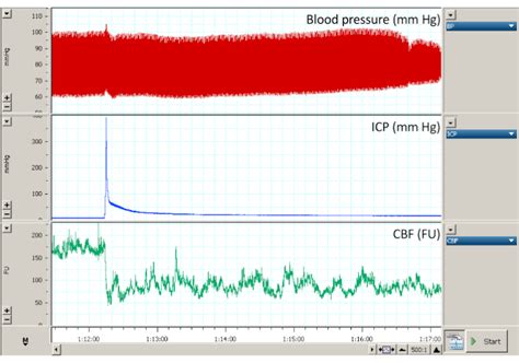 Establishing A Subarachnoid Hemorrhage Rat Model Induced By Autologous Establishing A Subarachnoid Hemorrhage Rat Model Induced By Autologous