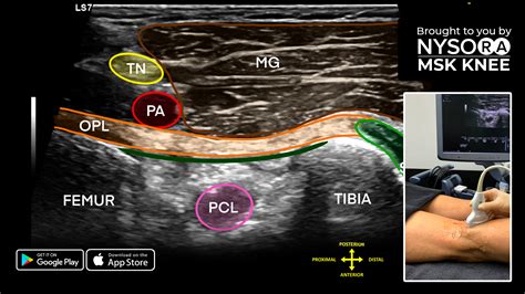 Suggerimento Msk Della Settimana Per La Scansione Del Legamento Popliteo Obliquo Nysora