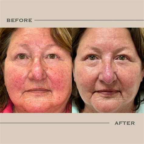 Patient 124623 Broadband Light Bbl Before And After Photos New York