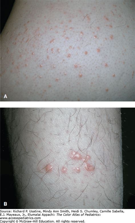 Hyperlipidemia And Xanthomas Obgyn Key