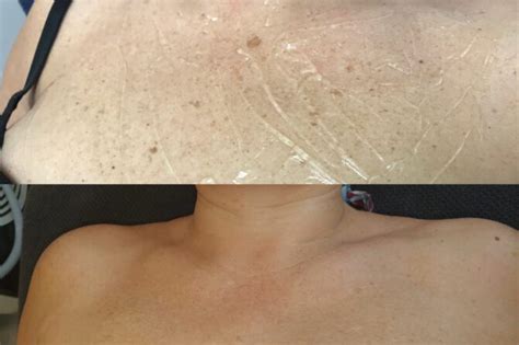 Pigmentation Chest Tait Aesthetics