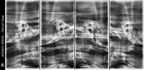Transcranial X Ray Of Tmj In Open And Closed Positions Affinity