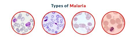What Are The 4 Types Of Malaria Ganesh Diagnostic