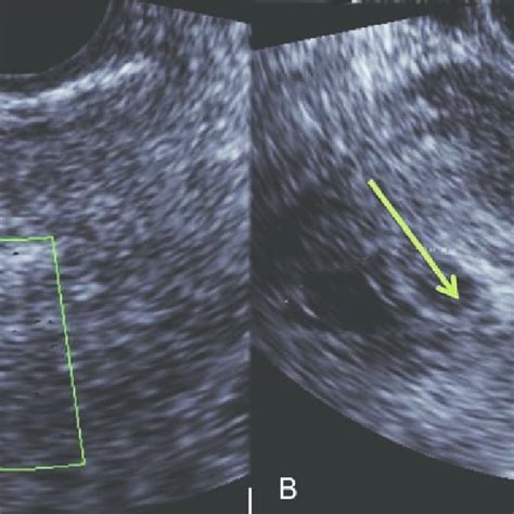 Longitudinal View Of A Normal Endometrial Cavity Outlined With Gel One