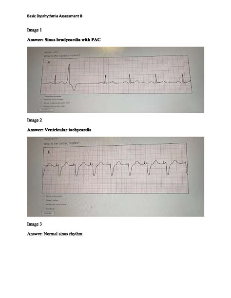 Relias Dysrhythmia Basic Test 35 Questions And Answers 2024 Basic