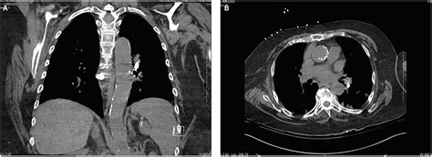 Femoral Access Retrieval Of Dislodged Leadless Pacemaker From The