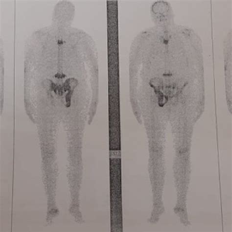 Whole‐body Bone Scintigraphy Showing High Osteoblastic Activity In The Download Scientific