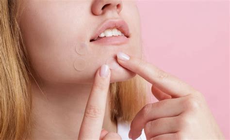 Puntos Blancos Después De La Microaguja Causas Prevención Y Consejos